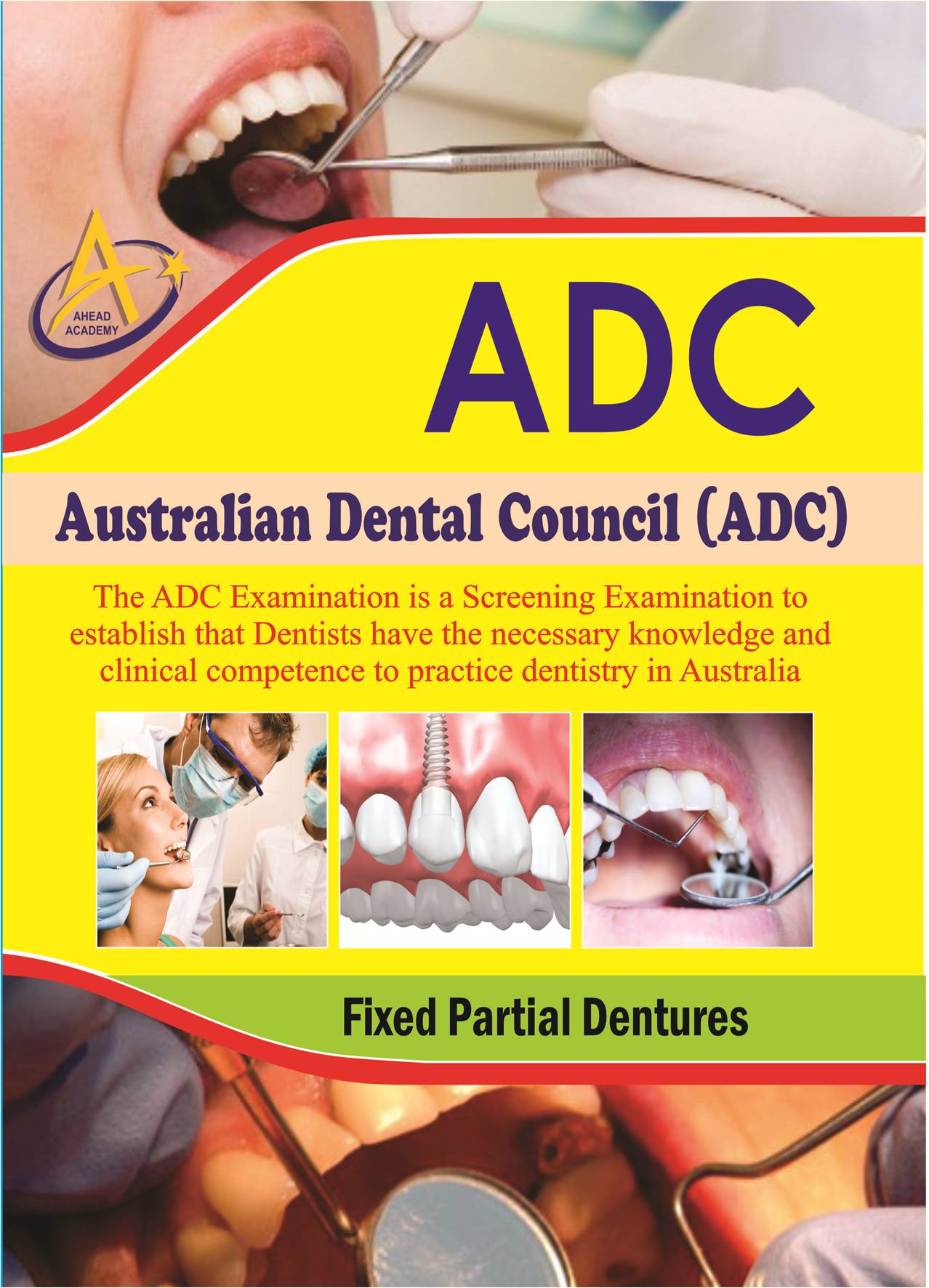 FIXED-PARTIAL-DENTURE-32-1 | Ahead Academy